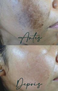 Manual Do Melasma - Curso Completo Aline Brito Estética em Ação É Bom?